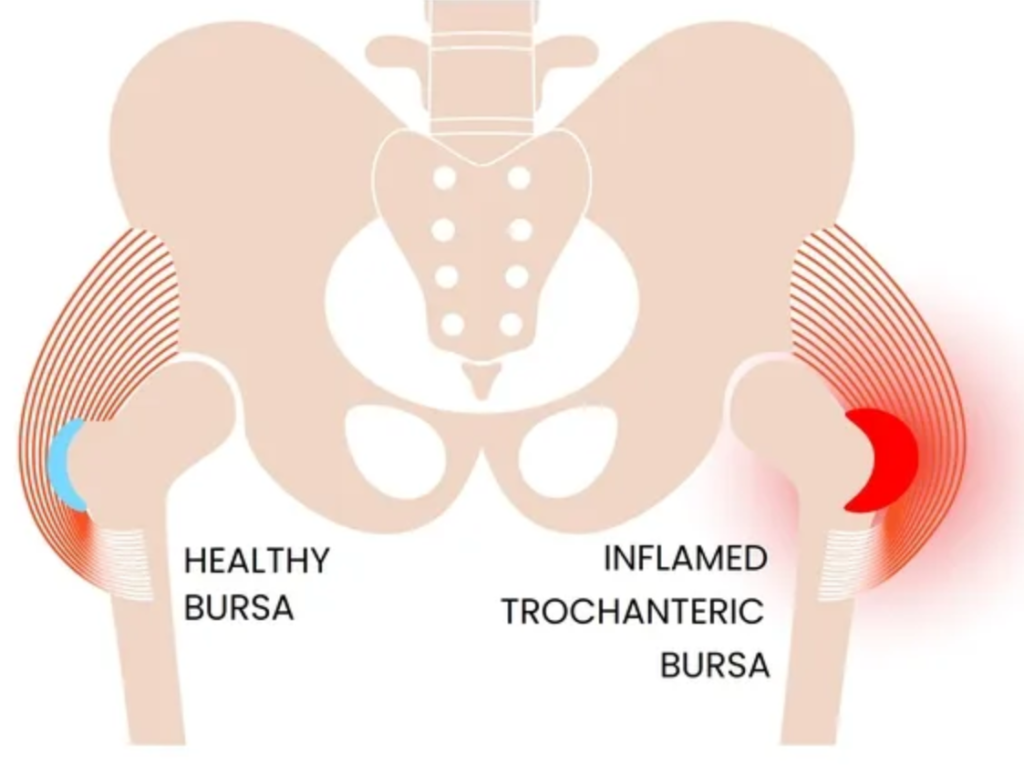 Understanding Hip Bursitis: Physio 101 - Urgent Care Physiotherapy Clinic & Rehabilitation ...
