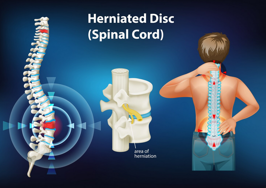 Physiotherapy Tips: How to Prevent Back Pain Shoveling this Winter ...